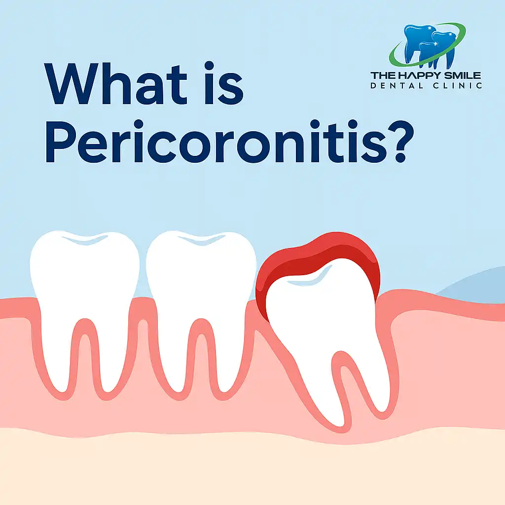 醴 Pericoronitis Treatment for Wisdom Tooth | The Happy Smile Dental Clinic